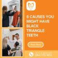 6 Proven Causes of Black Triangle Teeth | HQ Temple Dentist