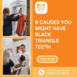 6 Proven Causes of Black Triangle Teeth | HQ Temple Dentist